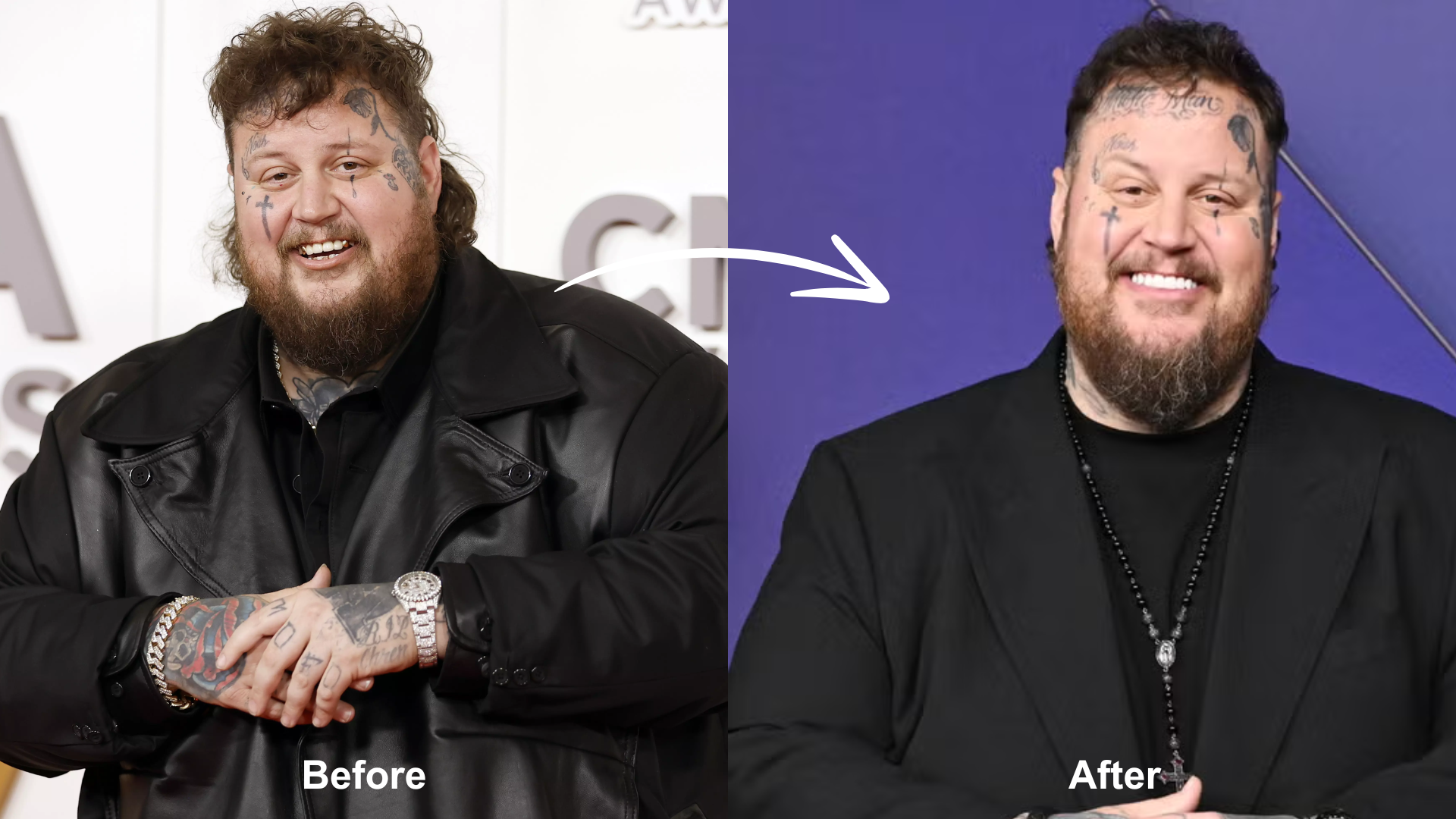 Did Jelly Roll Have Weight Loss Surgery?