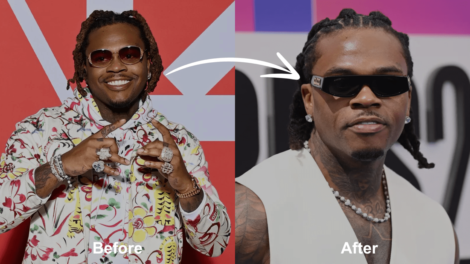 Did Gunna Have Weight Loss Surgery? - Bariatric Journal